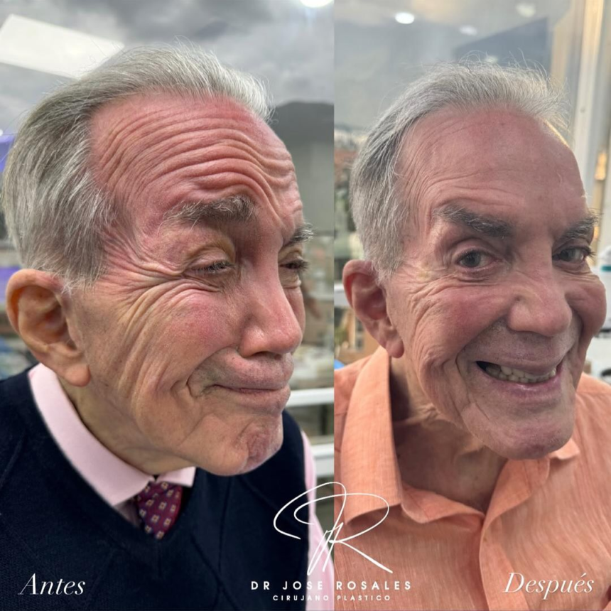 Así luce Gilberto Correa luego de su retoque facial a sus 81 años ...